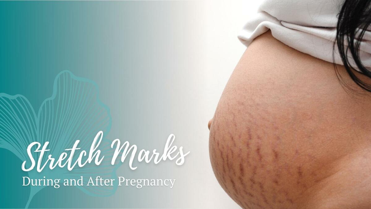Stretch Marks During Pregnancy | Stork Helpers